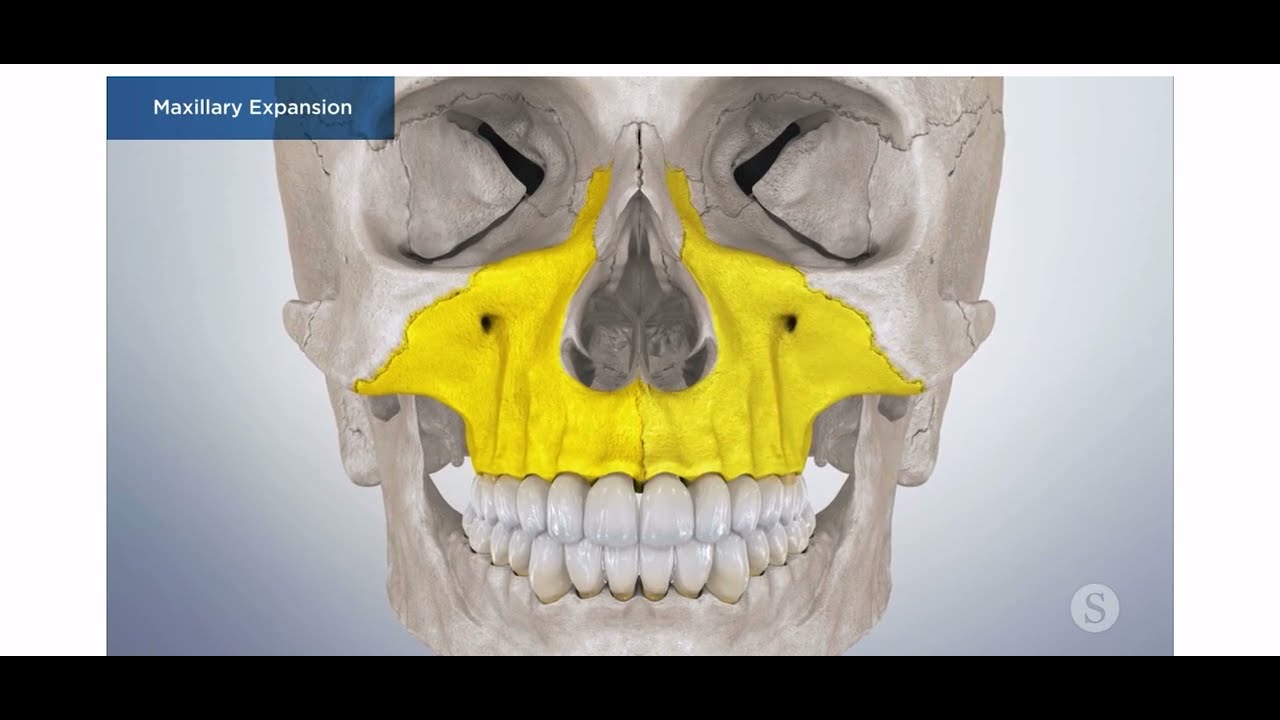 Maxillary Skeletal Expansion - YouTube