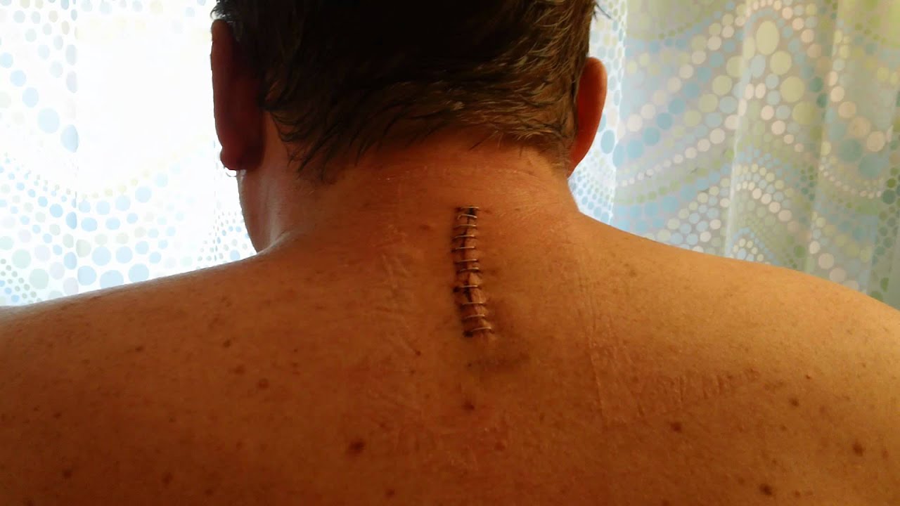 Staples in My Neck - YouTube