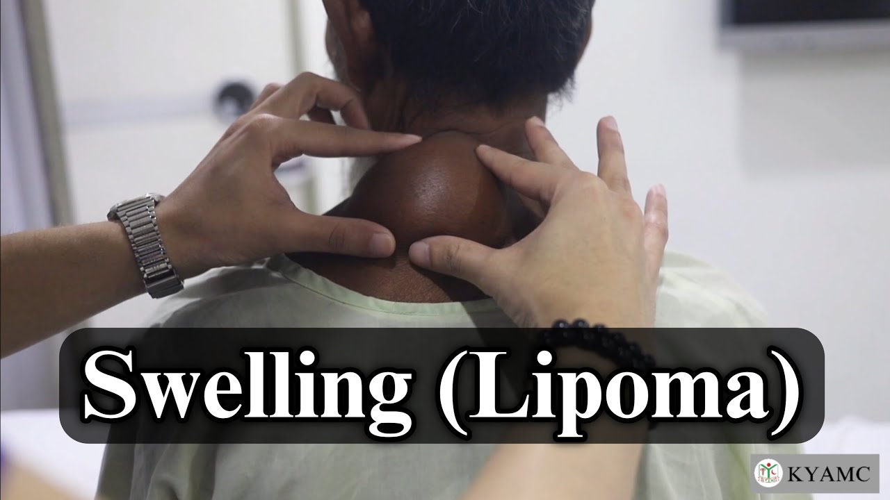 Examination of a Swelling ( Lipoma ) | Standardized Clinical ...