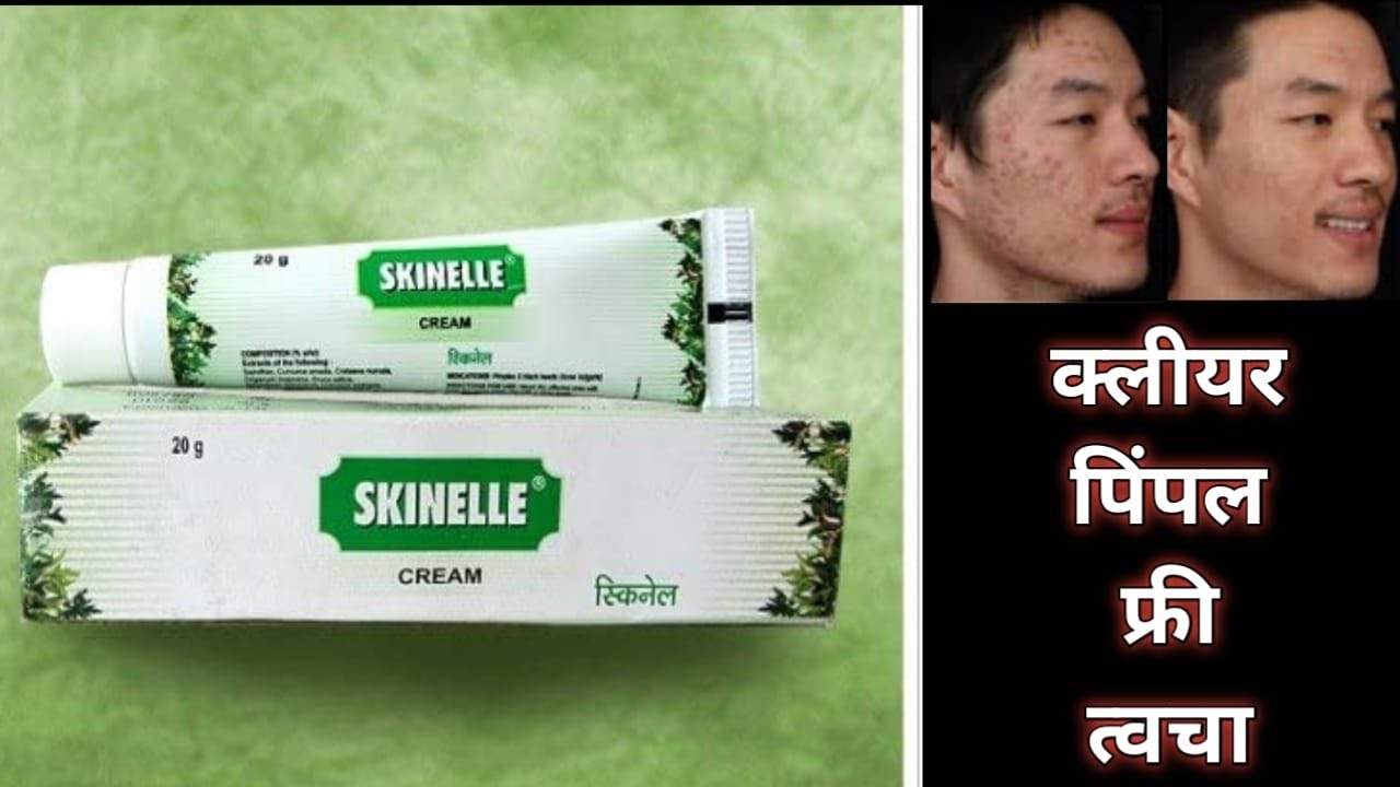 Skinelle Cream || आयुर्वेदिक क्रीम || दाग धब्बे, झाइयां कील मुंहासे ...