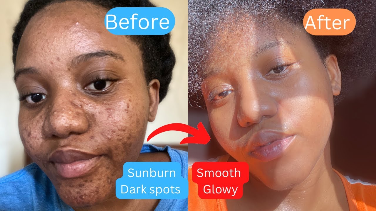 How I got rid of dark spots and got a clearer skin - YouTube