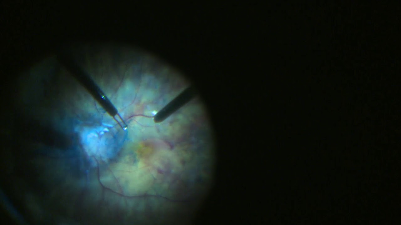 ILM Peeling in High Myopia - YouTube