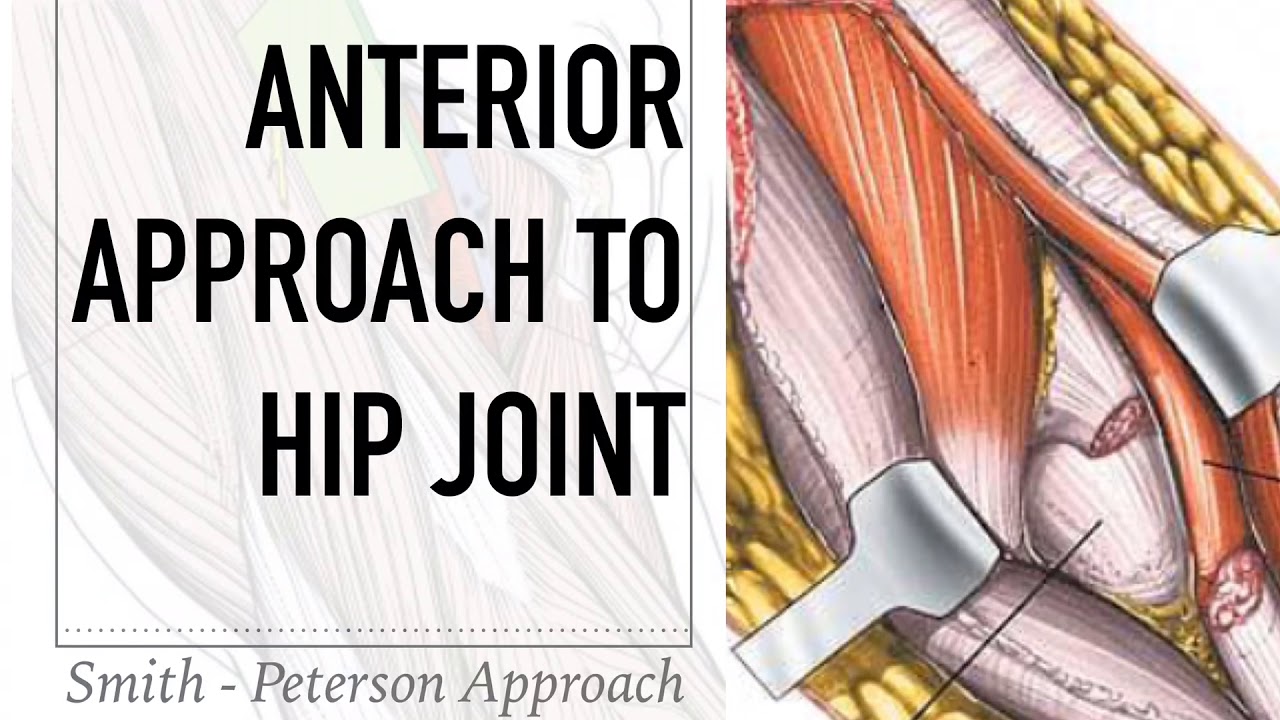 Anterior Surgical Approach to Hip joint (Smith Peterson Approach) - YouTube