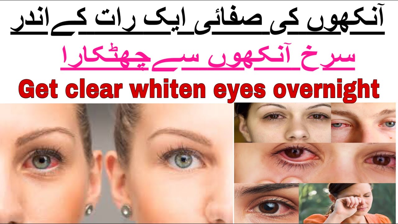 How to get clear bright eyes naturally| Get rid of red,swollen eyes|Grt ...