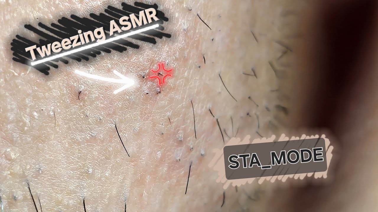 Satisfying Ingrown Hair Extraction from Beard – Pure Tweezing ASMR ...