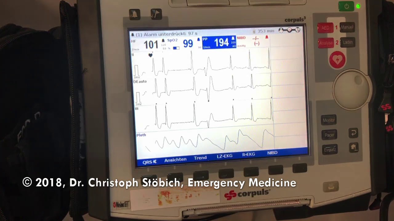 Supraventricular Tachycardia (SVT) Cardioversion with Adenosine ...