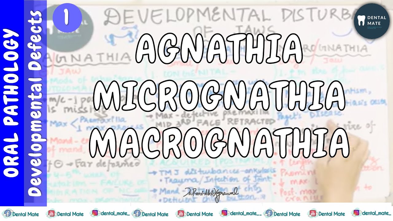 Developmental Disturbances of Jaw | Agnathia | Micrognathia ...