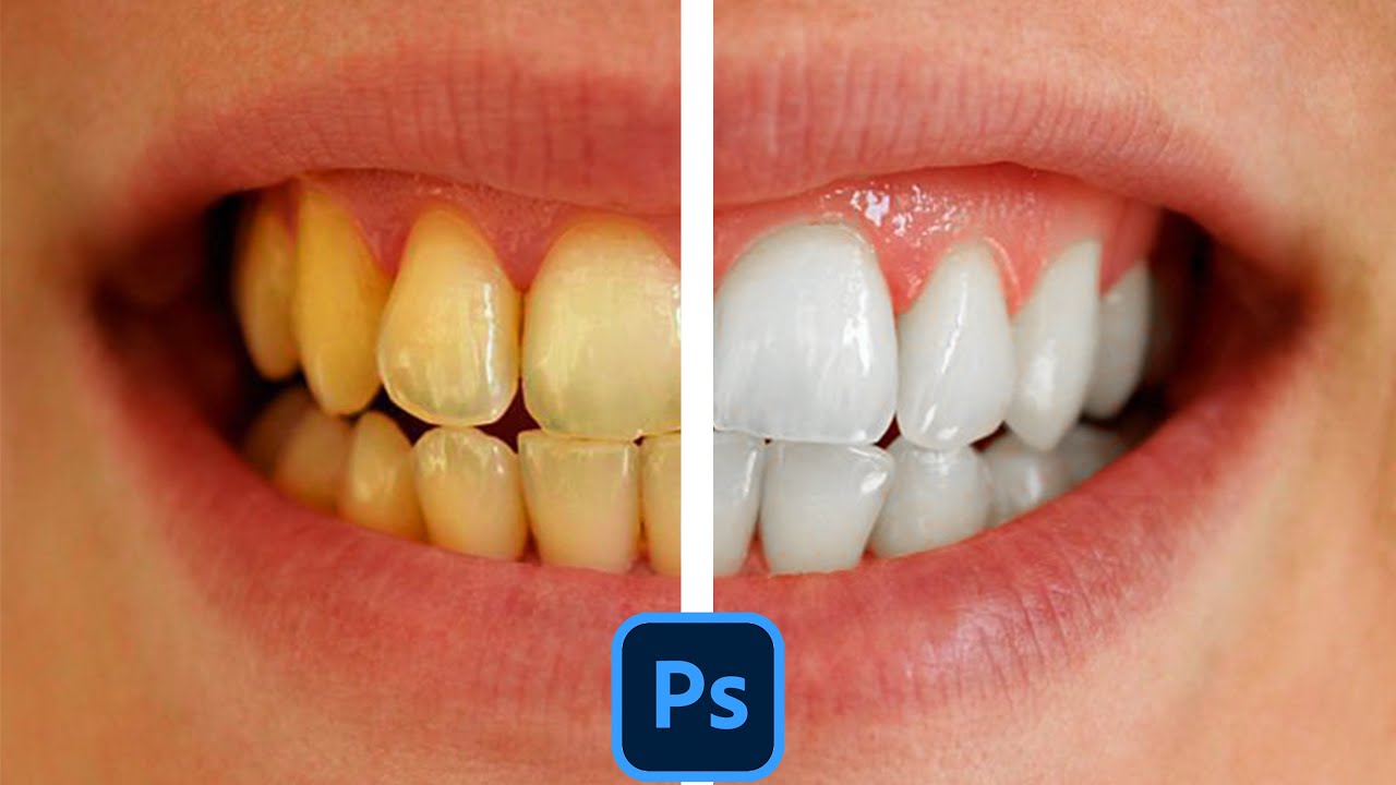 How to Remove Yellow Teeth and Whiten Teeth in Photoshop (Step-by-Step ...