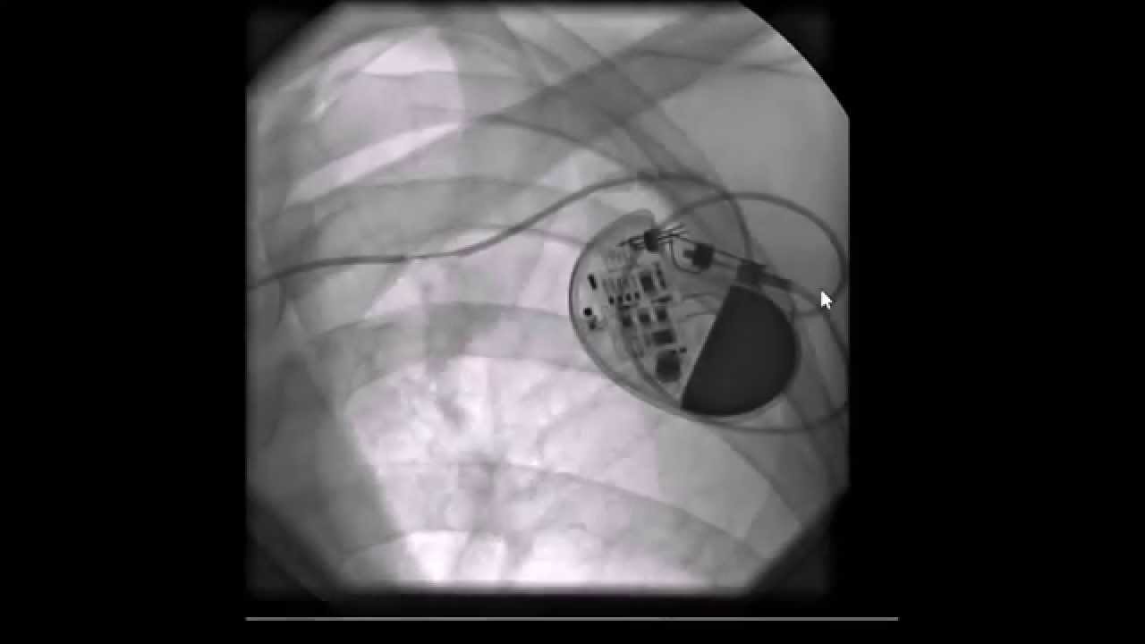 Crushed pacemaker lead between clavicle and first rib - YouTube