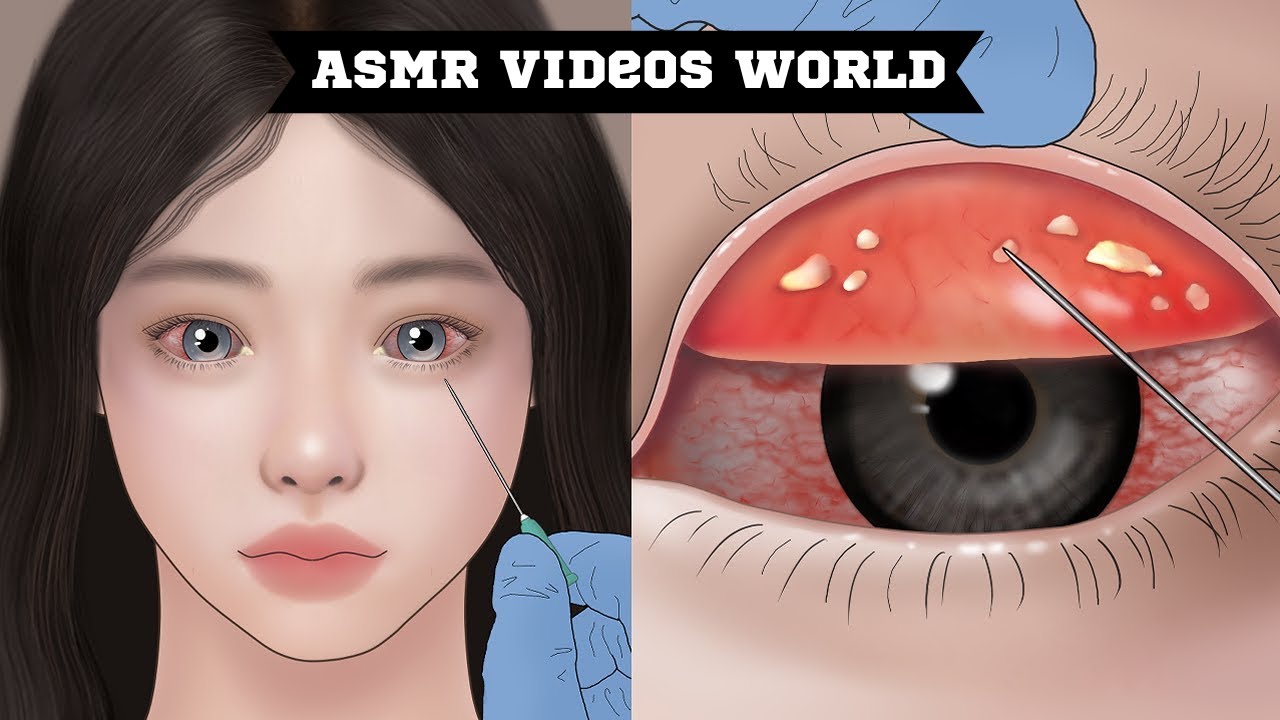 ASMR Eye Treatment animation - Eyelid big acne extrusion and lashes ...