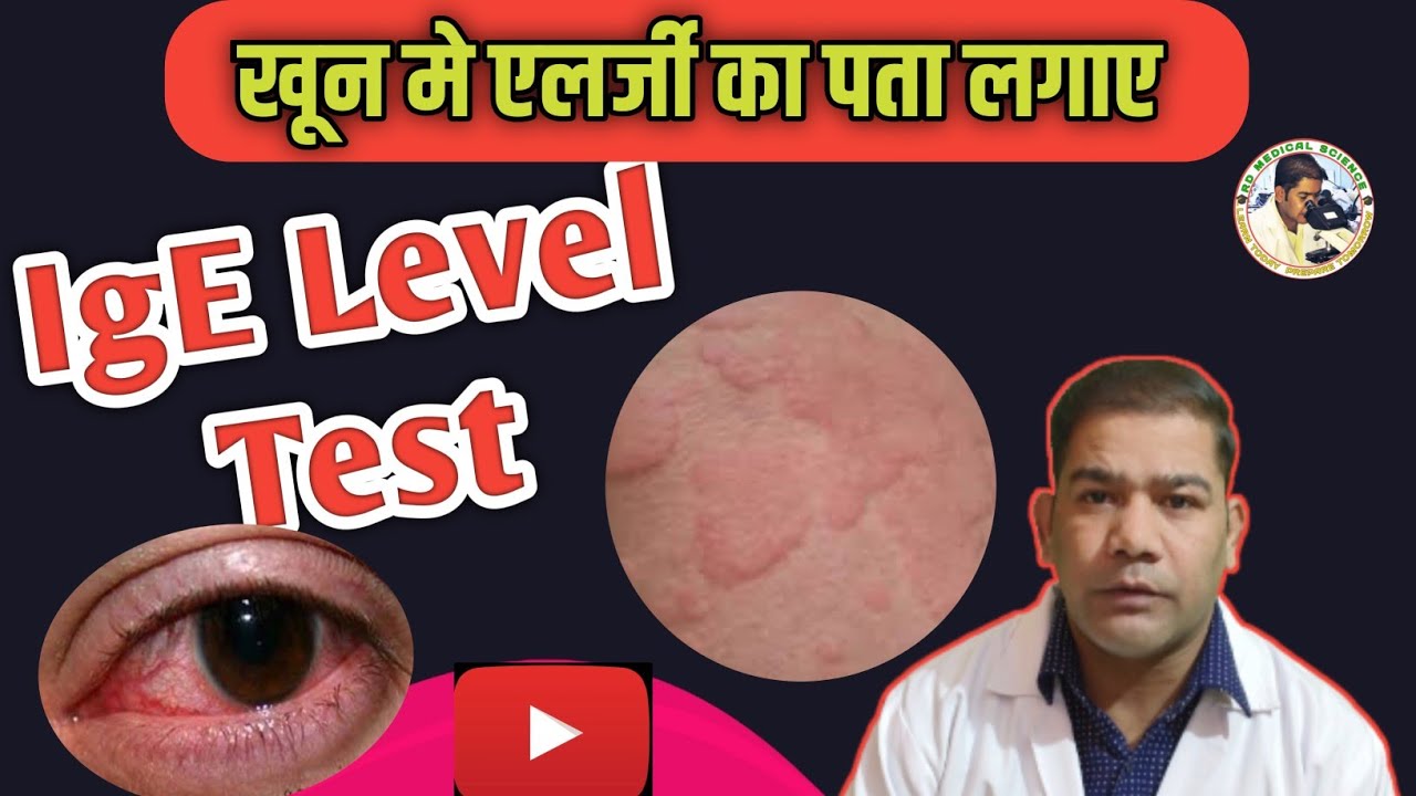 IgE Test | IgE Test Kya Hota Hai | IgE Level |#allergytest #HighIgE ...