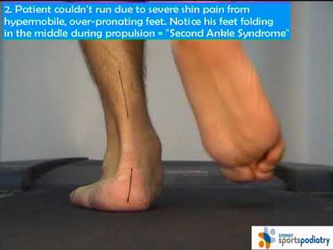 Pronation, Hypermobility, Second Ankle Syndrome and Heel Skive Wedge ...