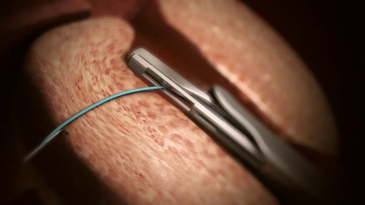 Texas Urology Specialists Urolift Procedure Animation YouTube