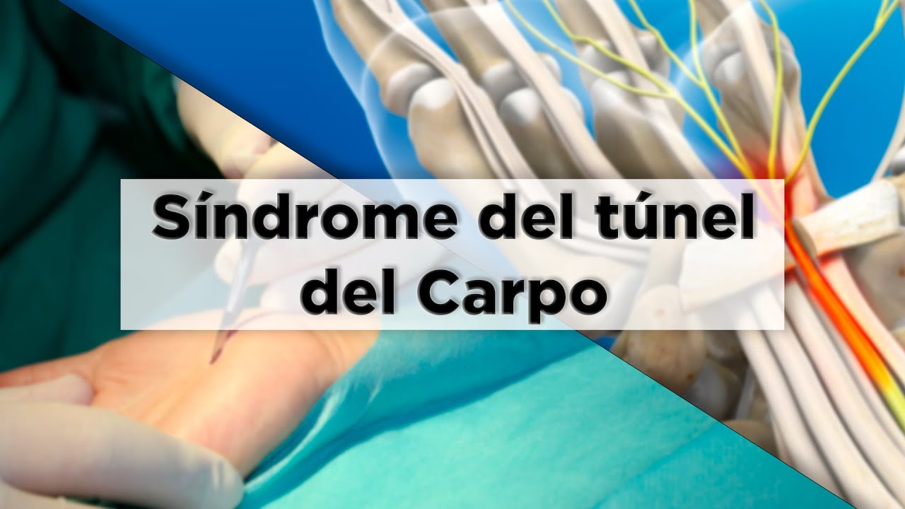 Túnel del carpo, desde la anatomía hasta el tratamiento - YouTube Music