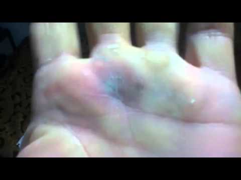 Paint gun injury - YouTube