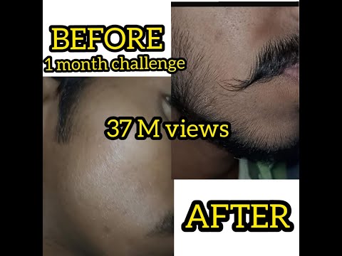 minoxidil 1 month result 🥵🔥 secret trick to gain 100%results