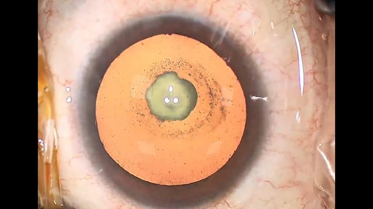 Large Posterior Polar Cataract (PPC) with posterior capsule deficit ...
