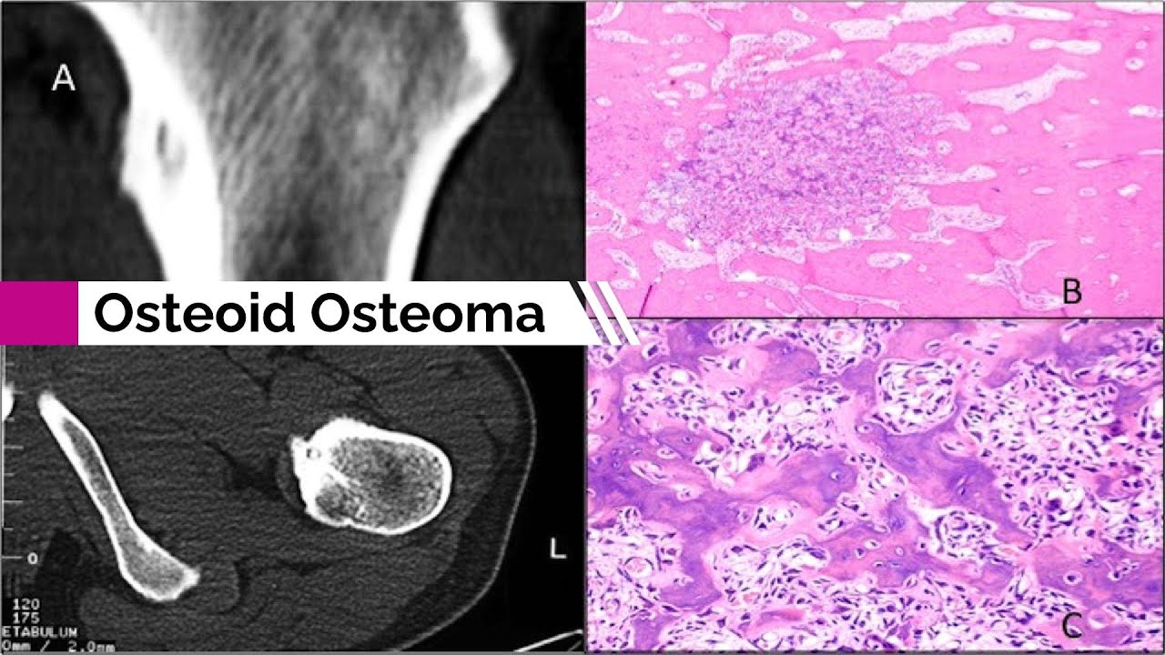 Osteoid Osteoma Tümörü: Belirtileri, Nedenleri ve Tedavi Yöntemleri ...