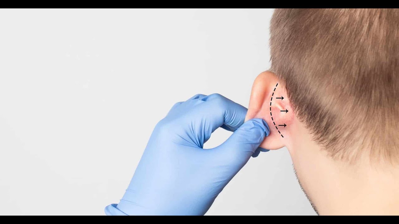 Otoplasty Recovery Day by Day | Ear Surgery Recovery | Lyfboat - YouTube