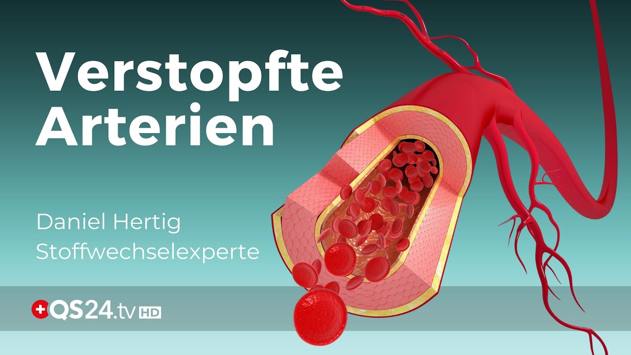 Arterienverstopfung: Wann muss operiert werden? | Alternativmedizin ...