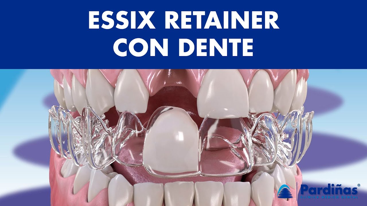 ESSIX retainer con dente - Una soluzione provvisoria per i DENTI ...
