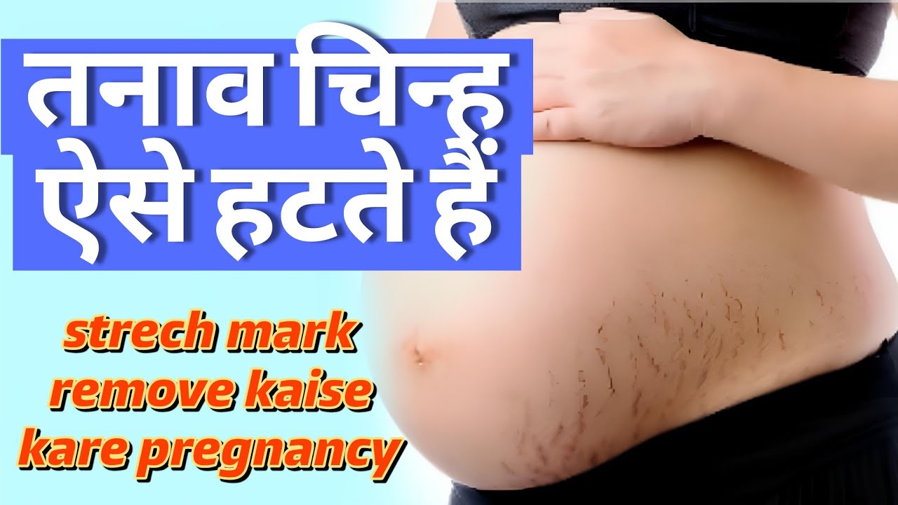 how to remove strech mark of pregnancy - YouTube