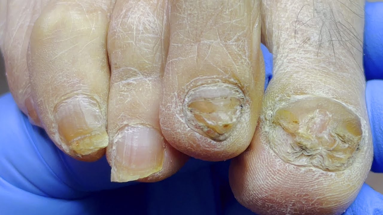 1 year untrimmed hard nails, smelly and hard - YouTube