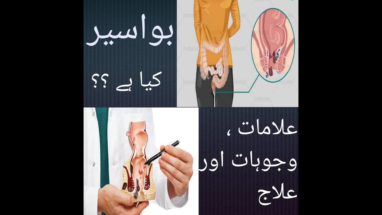 Piles Hemorrhoids Bawaseer Bawaseer Kya Hota Hay Causes