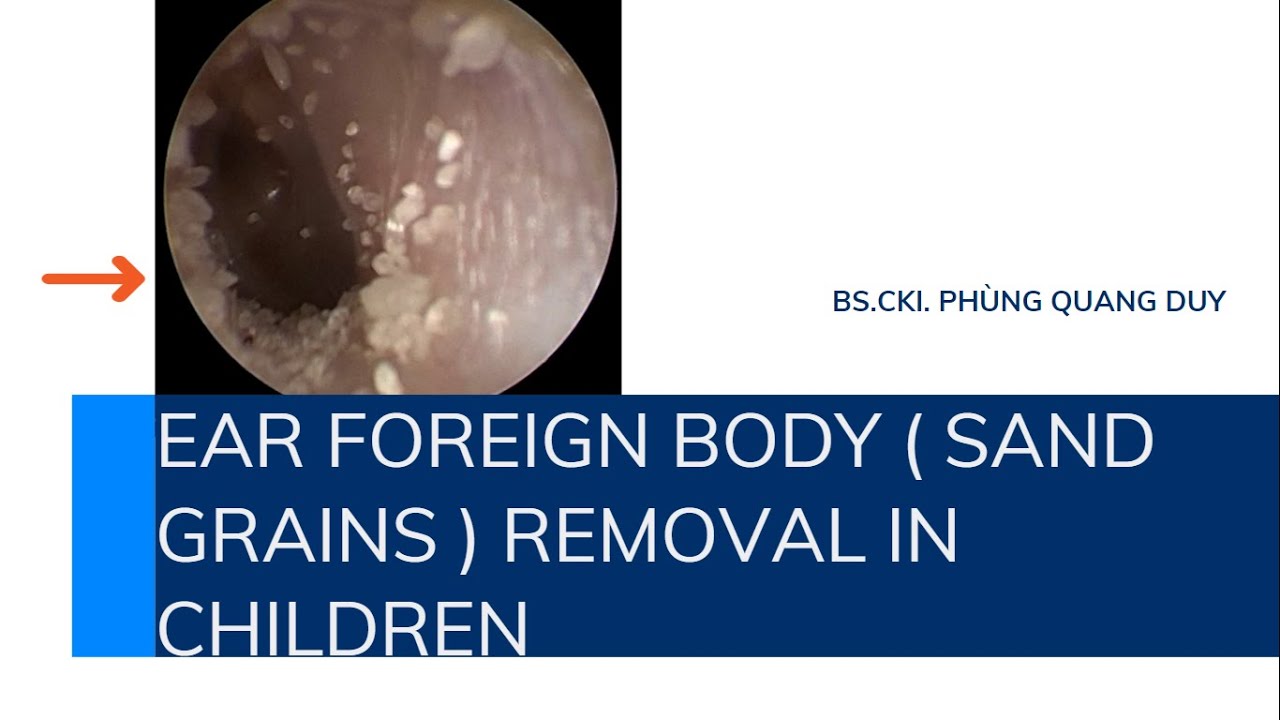EAR FOREIGN BODY ( SAND GRAINS ) REMOVAL IN CHILDREN - YouTube