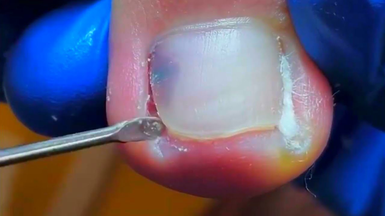 Step By Step To Remove Ingrown Toenail With Great Result 【Yinuo ...