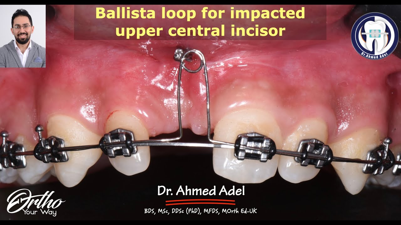Ballista loop for buccal impacted central incisor - YouTube