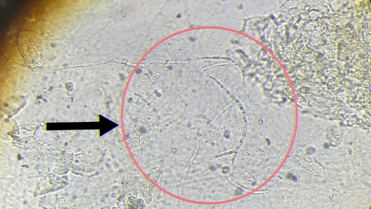 Examen de Orina: ¿Por Qué los Eritrocitos y Leucocitos Son Claves en ...