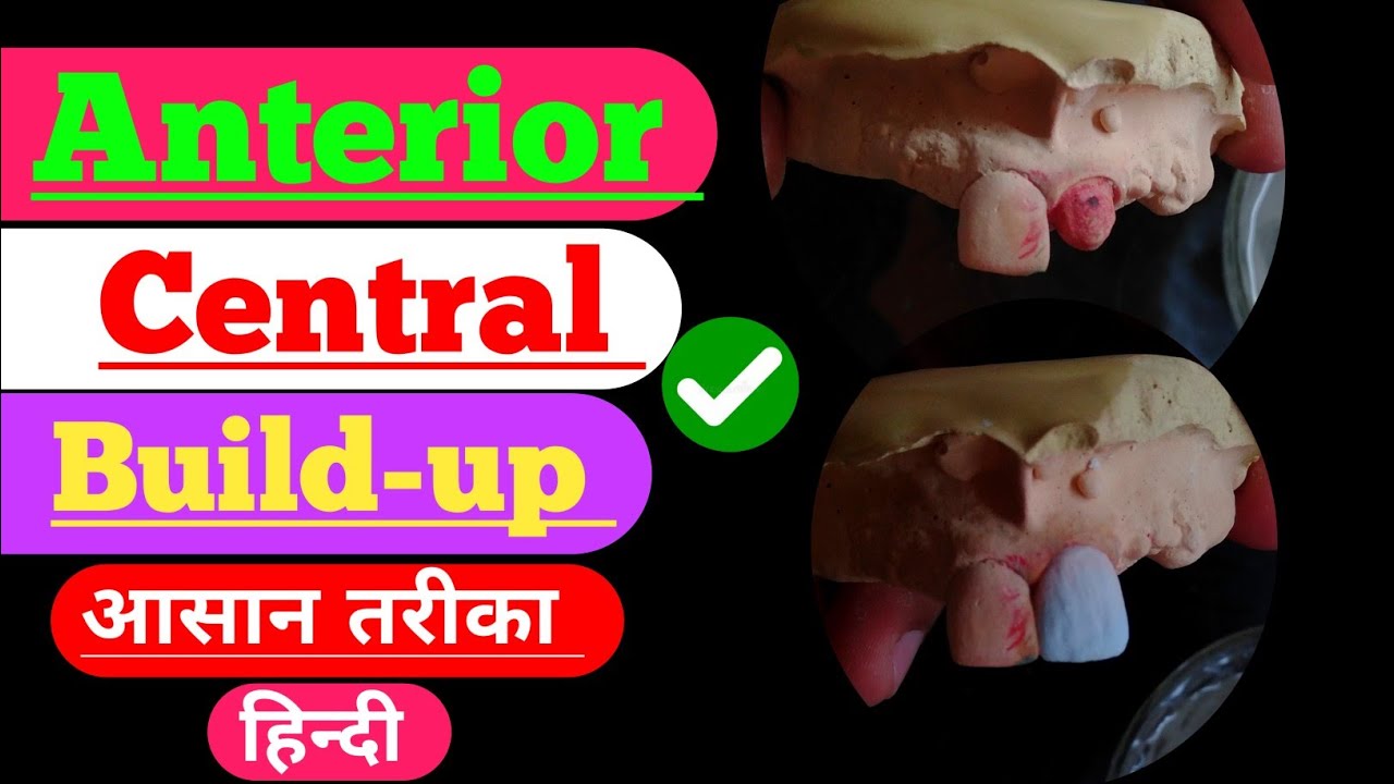 Central Porcelain|| Laboratory|| smile|| Ceramic|| Build up|| Technique ...