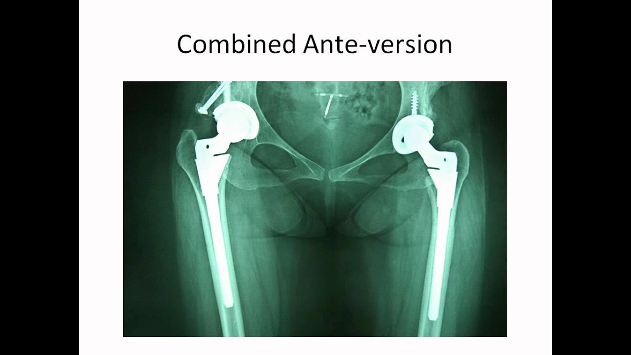 Replace high riding hips - Scientific basis for clinical decision - YouTube