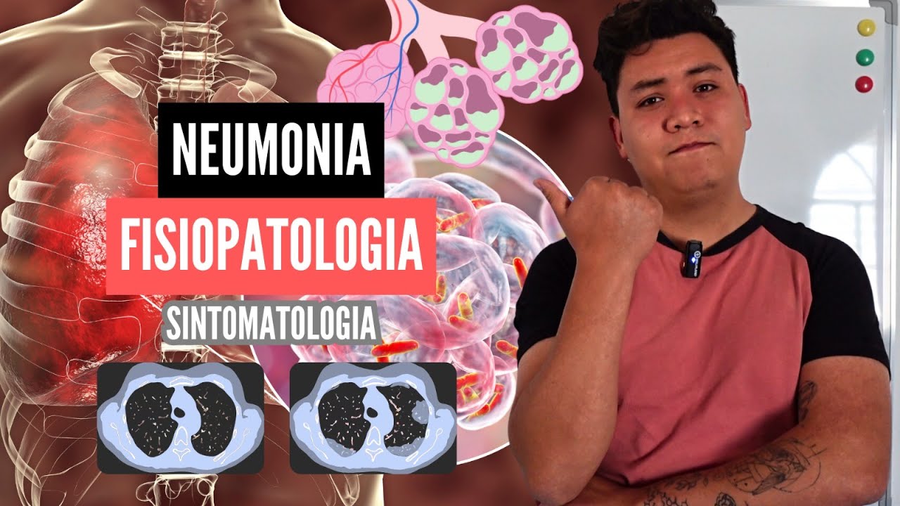 FISIOPATOLOGIA de la NEUMONIA | FASES de la NEUMONIA y SINTOMATOLOGIA ...
