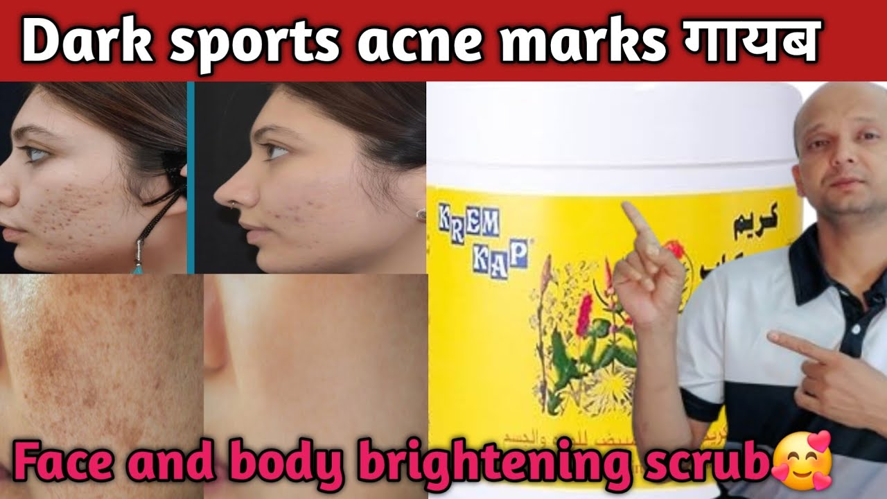 Krem kap Best scrub for darksports | Acne marks treatment - YouTube
