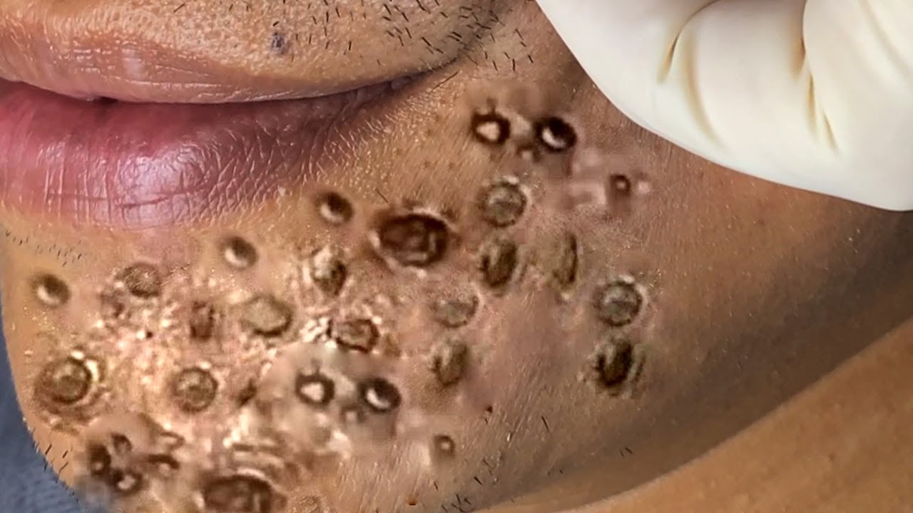 𝐌𝐨𝐬𝐭 𝐒𝐚𝐭𝐢𝐬𝐟𝐲𝐢𝐧𝐠 𝐏𝐢𝐦𝐩𝐥𝐞𝐬 𝐑𝐞𝐦𝐨𝐯𝐚𝐥 𝐀𝐭 𝐇𝐨𝐦𝐞 #1564 - YouTube