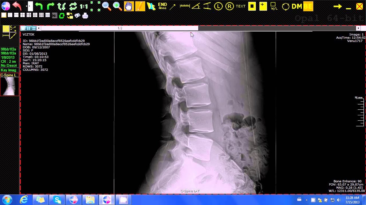 20/20 Imaging Opal-Rad (Chiropractic) Lumbar curve tool - YouTube
