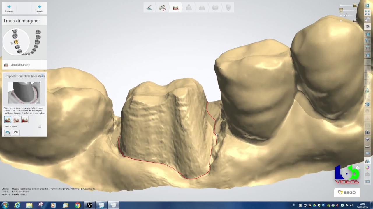 Modello Trios Model Builder 3Shape e cappetta Selective Laser Melting ...