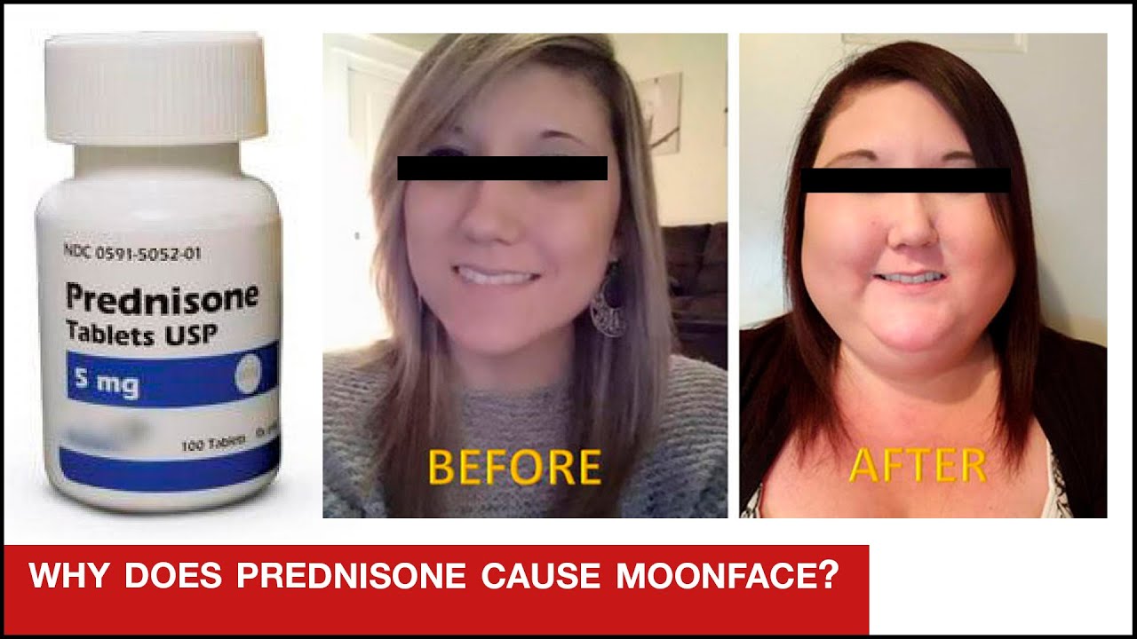 How To Lose Weight FAST || Prednisone Weight Gain Explained - YouTube
