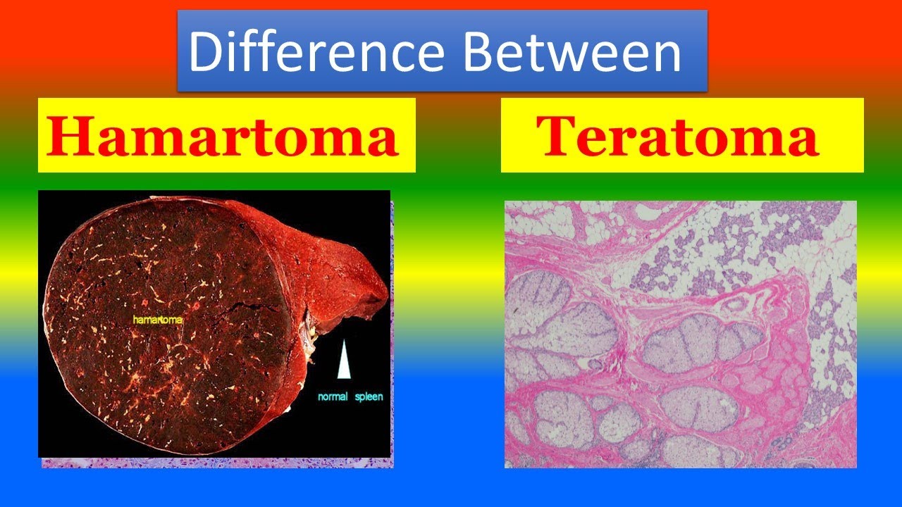Difference Between Hamartoma And Teratoma YouTube difference-between-hamartoma-and-teratoma-youtube