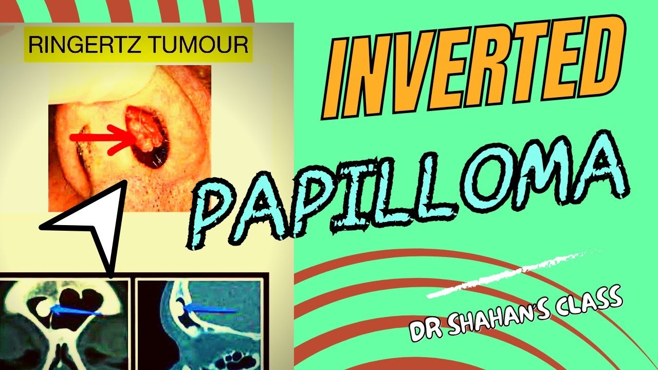 Inverted Papilloma | Ringertz Tumor | FMGE NEETPG INICET exams - YouTube