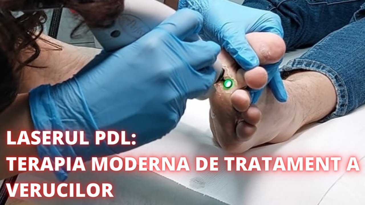 Eliminarea verucilor cu Laser Vascular PDL | DermaBeauty Clinique - YouTube