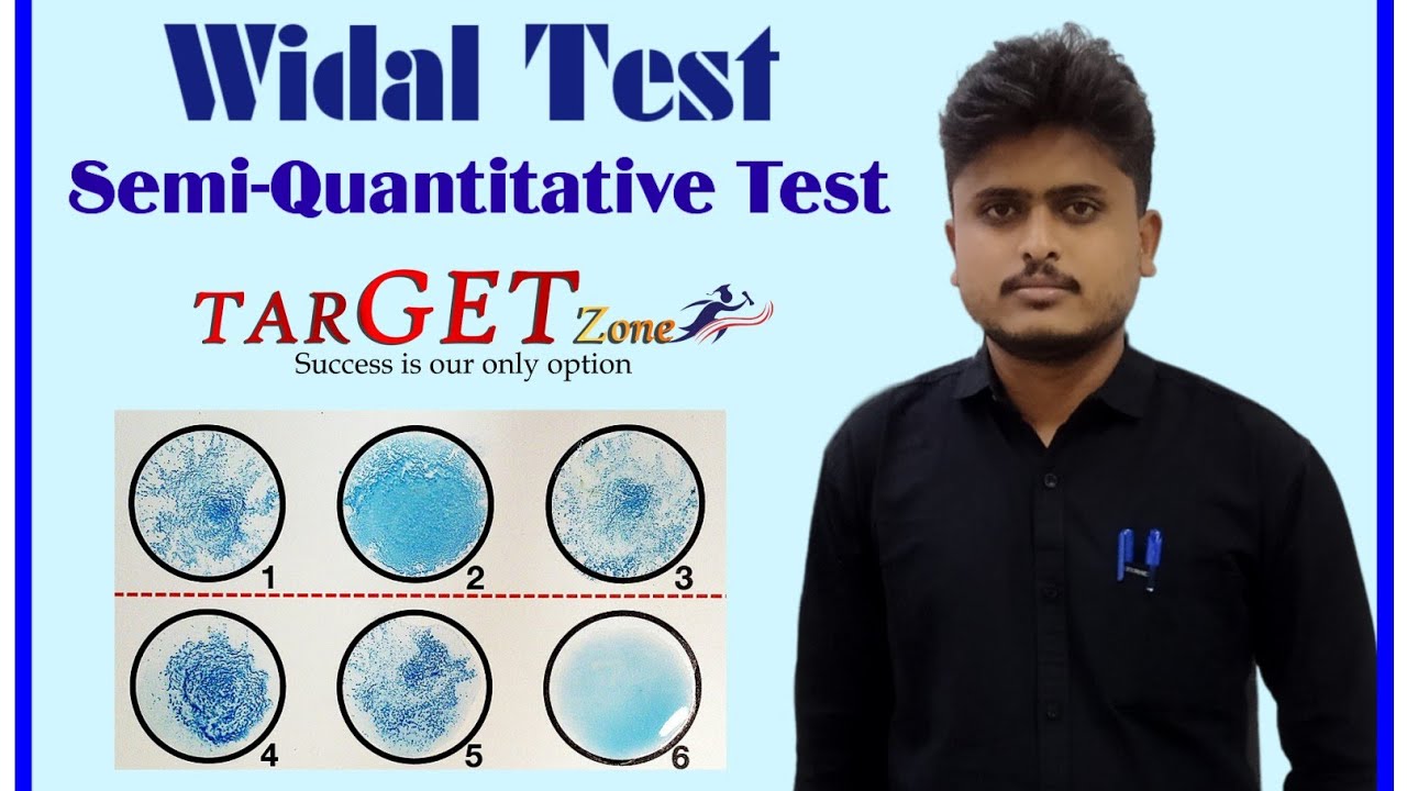 Widal Test Part 2 Semi Quantitative Test Procedure In Kannada Slide widal-test-part-2-semi-quantitative-test-procedure-in-kannada-slide