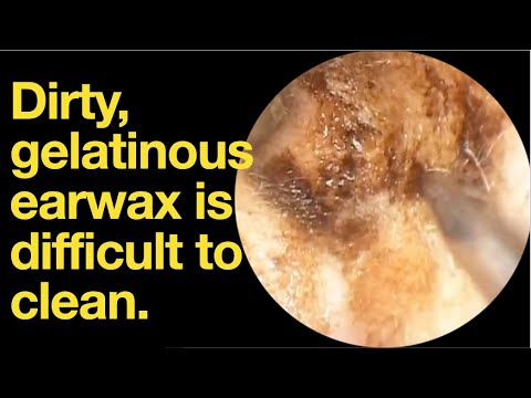 Dirty, gelatinous earwax is difficult to clean.|ear wax removal | ear ...