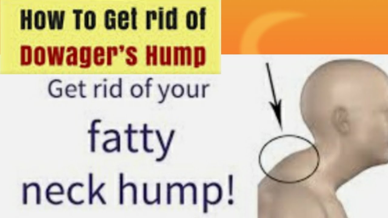 Get rid of Fatty neck hump/ Dowager's hump/ Hump in the neck/ Buffalo ...