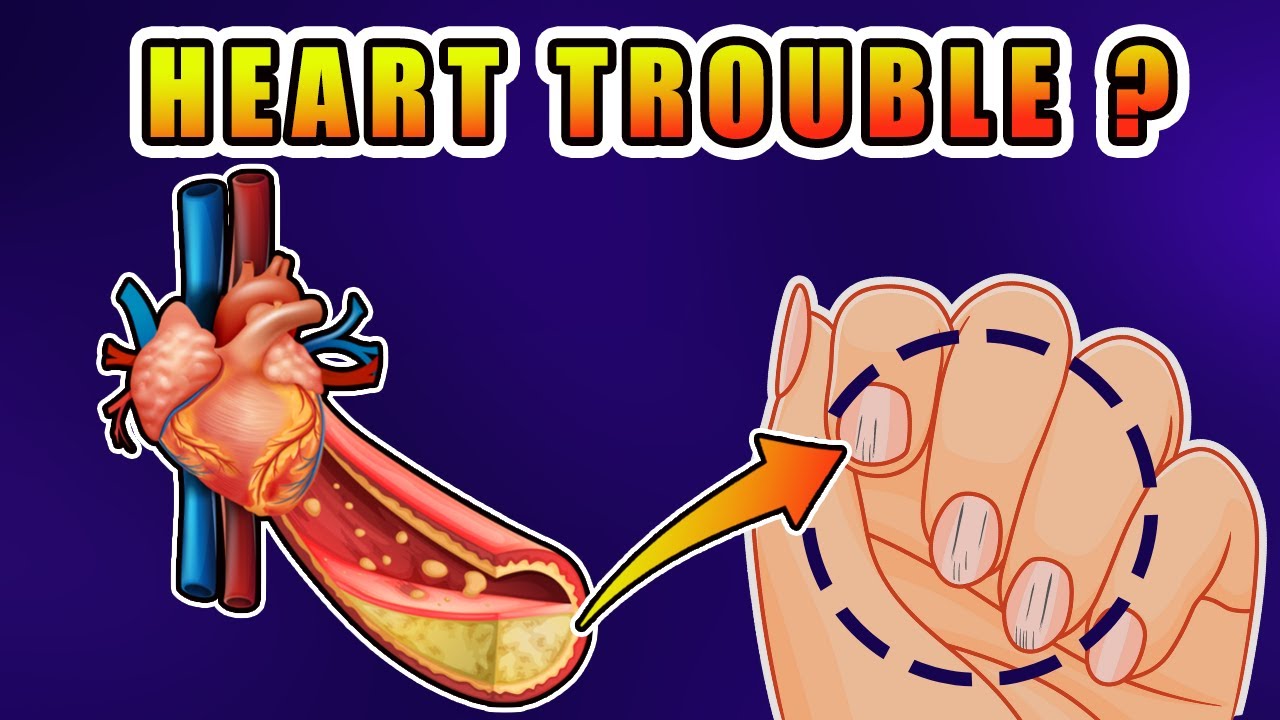 Top 5 Heart Disease Symptoms That Your Hands Can REVEAL - YouTube