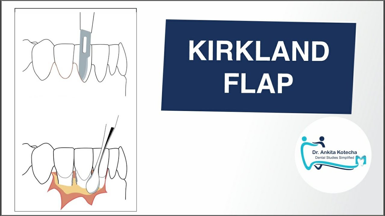 KIRKLAND FLAP/ ACCESS FLAP/ MODIFIED FLAP OPERATION/ PERIODONTAL FLAP ...