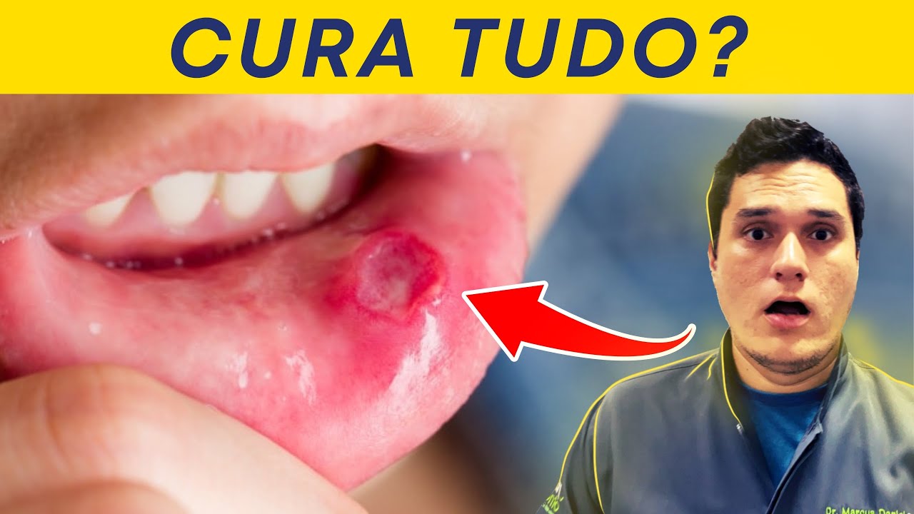 AFTAS NA BOCA: PRINCIPAIS CAUSAS E TRATAMENTOS! - YouTube