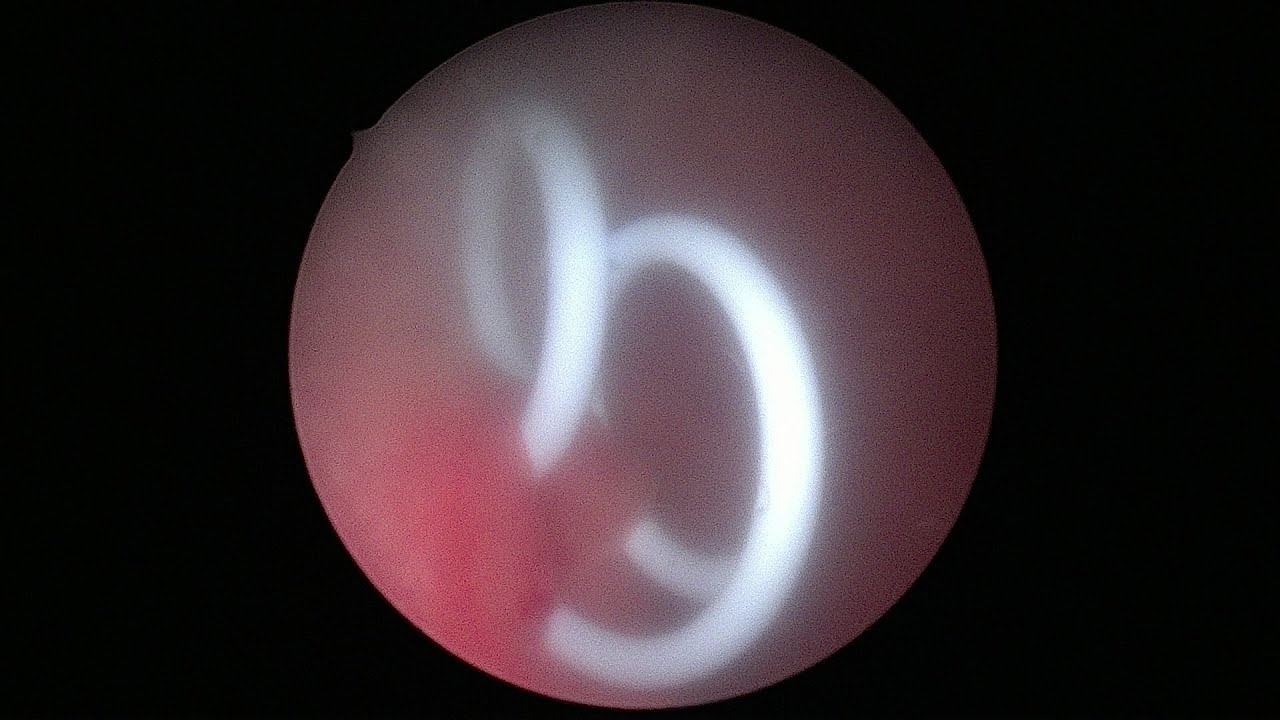 Right Ureterotomy for congenital hydronephrosis - YouTube